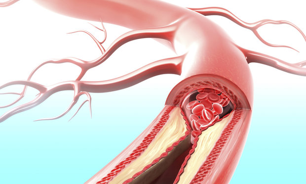 Vein surgeries for the treatment of varicose veins in Germany ...